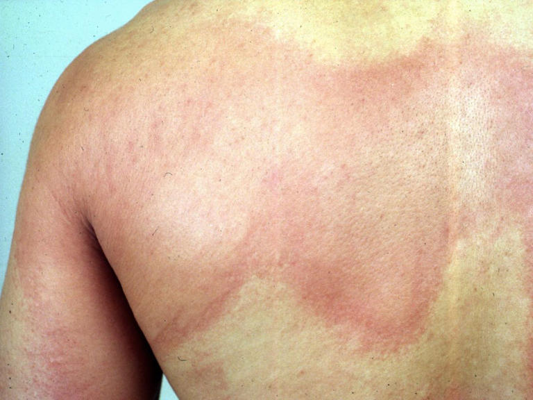 Can you recognize Lyme disease rashes from photos?