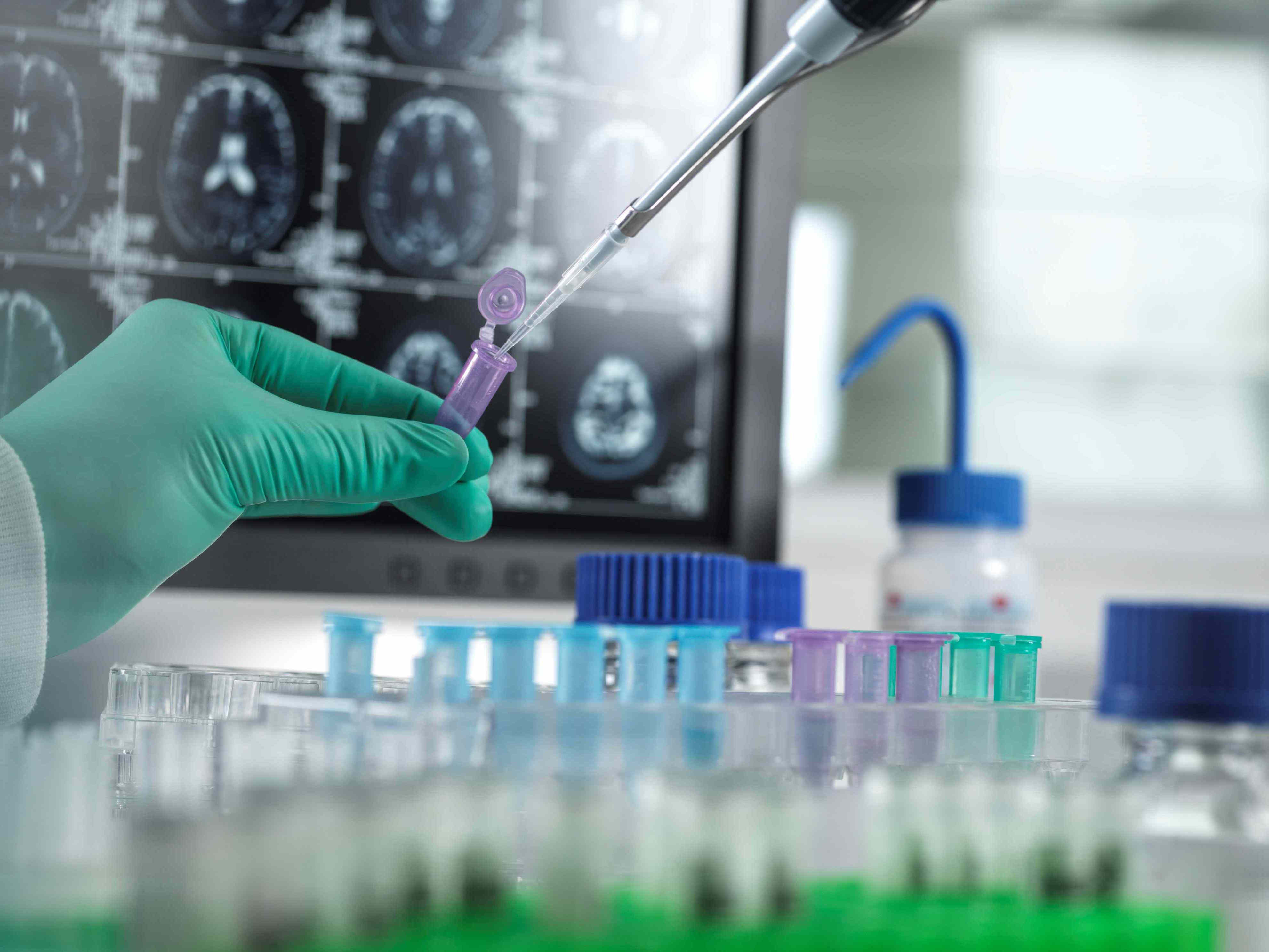 How is Huntington's disease diagnosed?