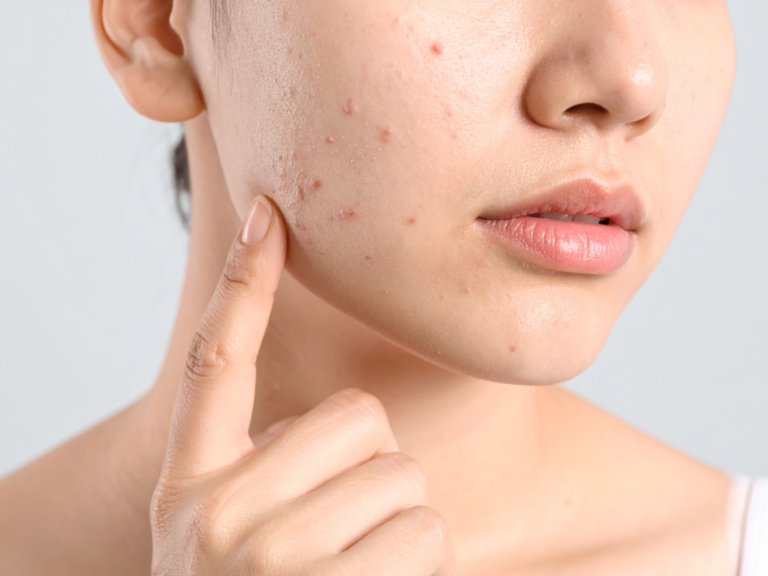 Clear skin naturally: Proven DIY natural acne treatments