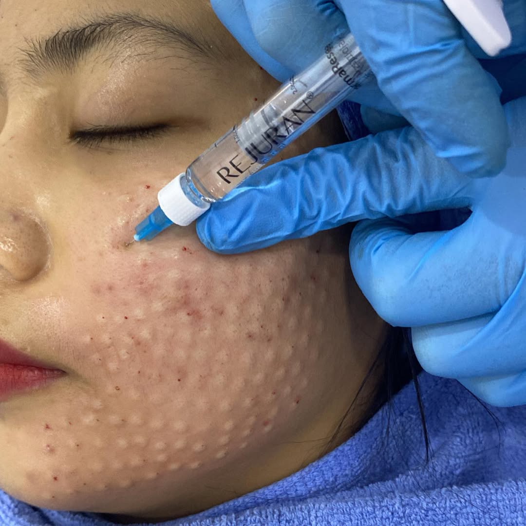 Rejuran injection: Why this skin-healing treatment is everywhere right now