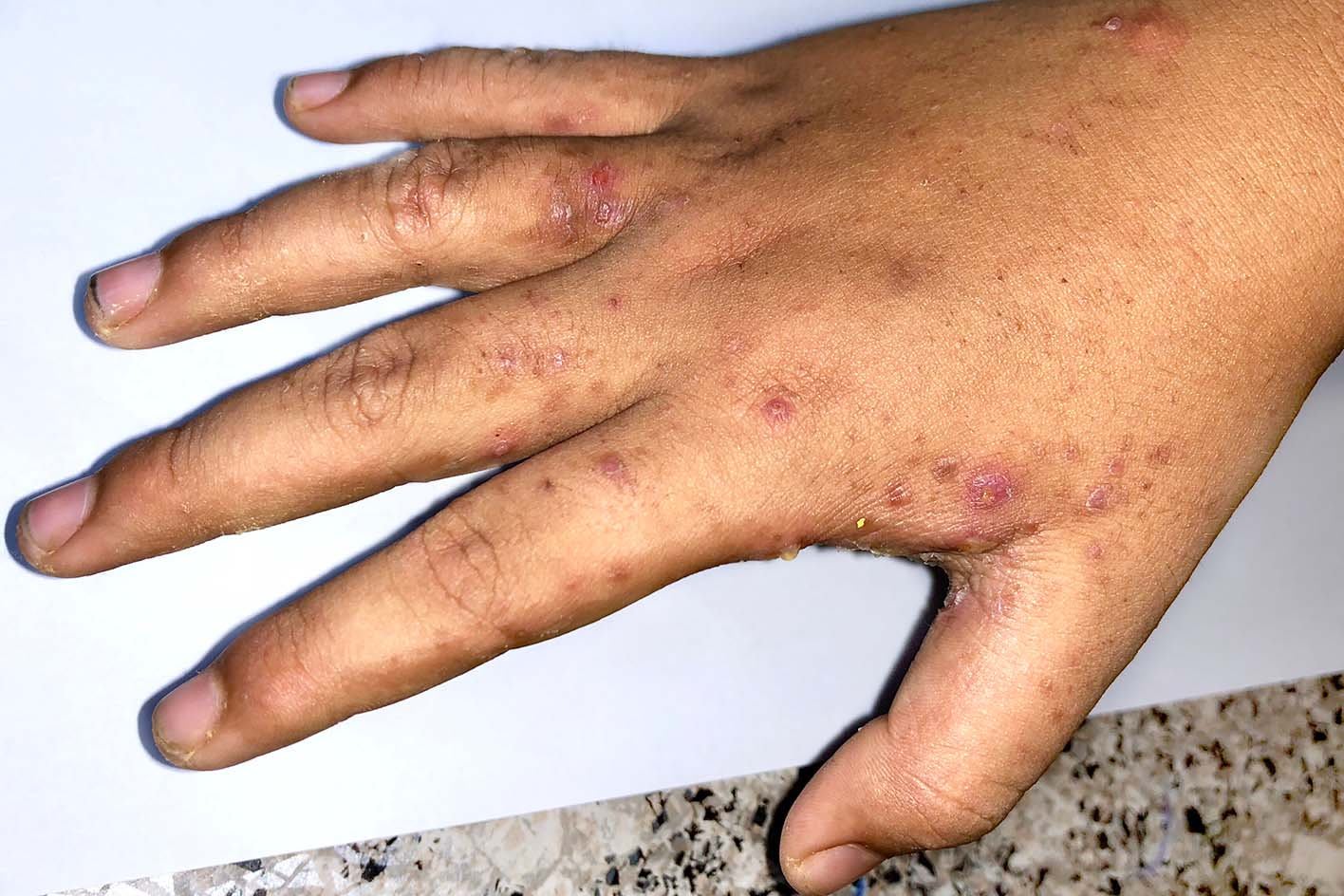 Scabies cases double the 5-year rolling average, UK households warned
