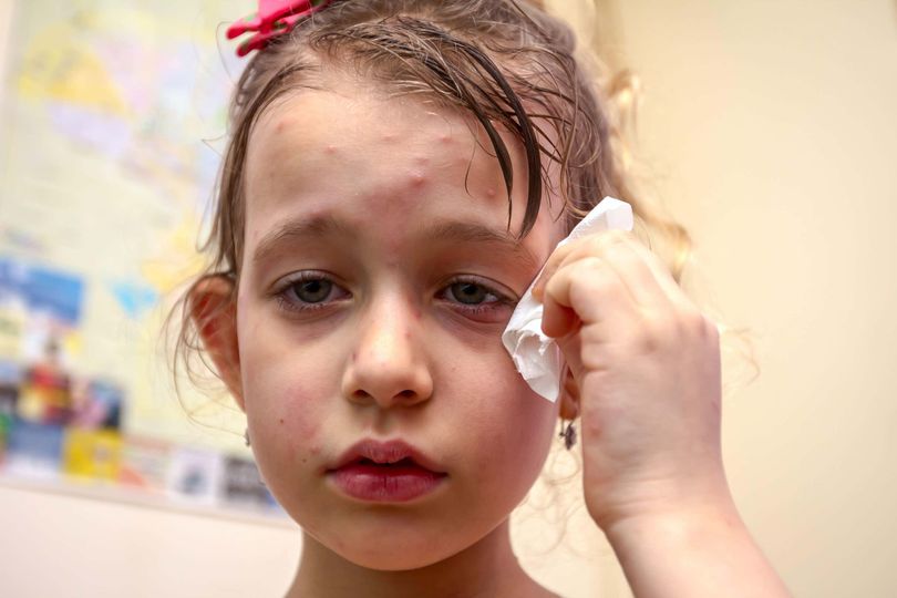 Urgent vaccine alert as disease 're-established' in UK after 'elimination'