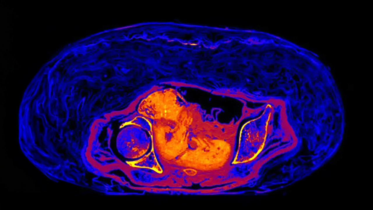 Why the fetus was never removed from Egypt’s pregnant mummy