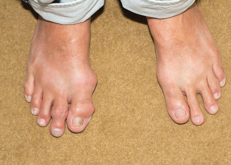 What is gout – and what are the early warning signs to look out for