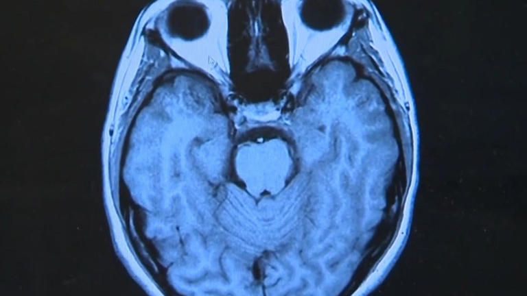 Recent Northwestern Medicine study used app to track symptoms, recovery ...