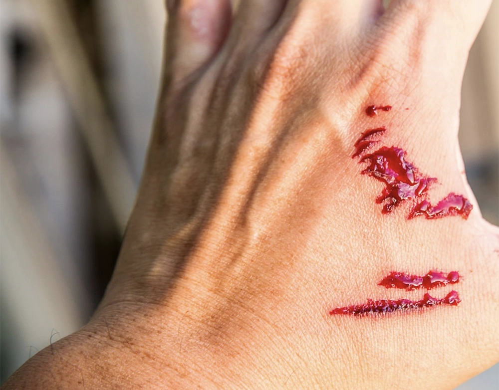 Dog attack PTSD: How state and local laws impact mental health recovery