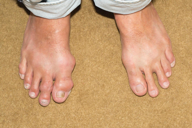 What is gout – and what are the early warning signs to look out for