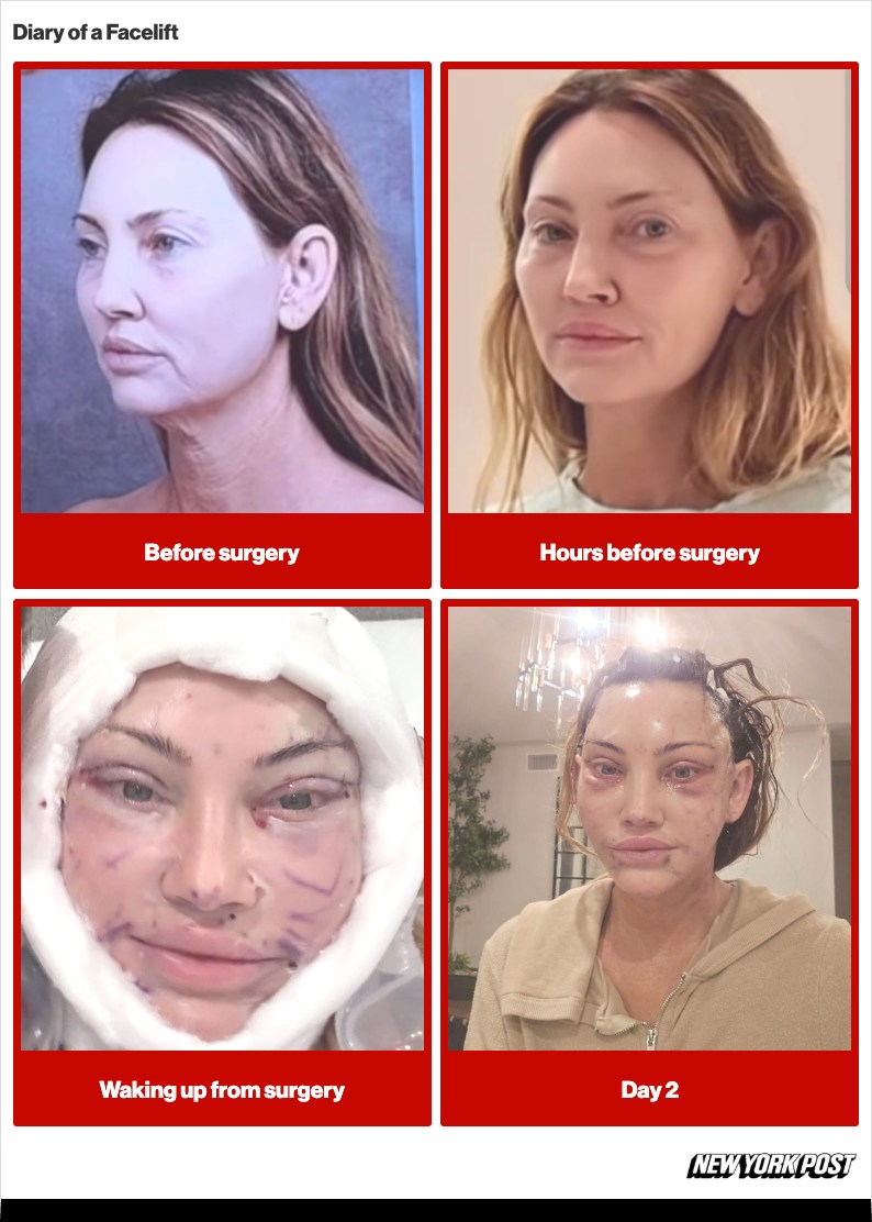 I had a $200,000 Beverly Hills facelift — and then shared every ...