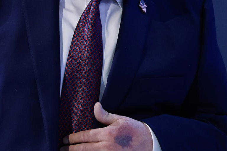 Donald Trump health mystery deepens as fresh bruises appear during ...