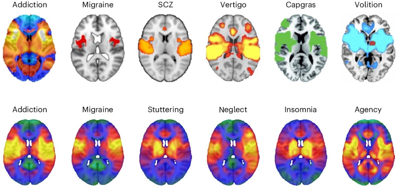 Popular brain mapping method found to lack disorder-specific accuracy