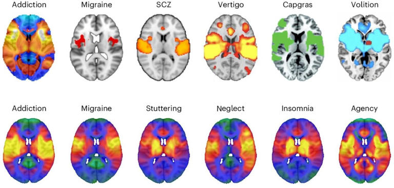 Popular brain mapping method found to lack disorder-specific accuracy