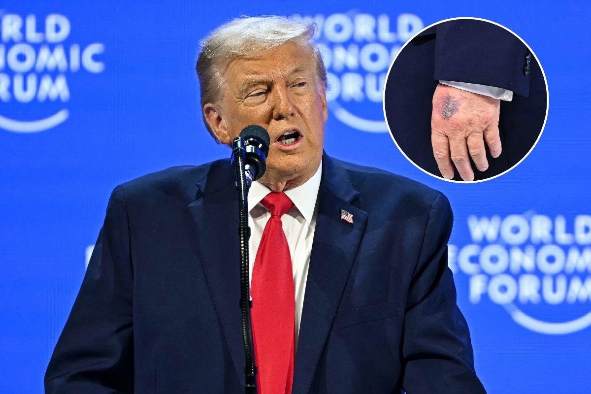 President Trump responds to questions about noticeable bruise on left hand