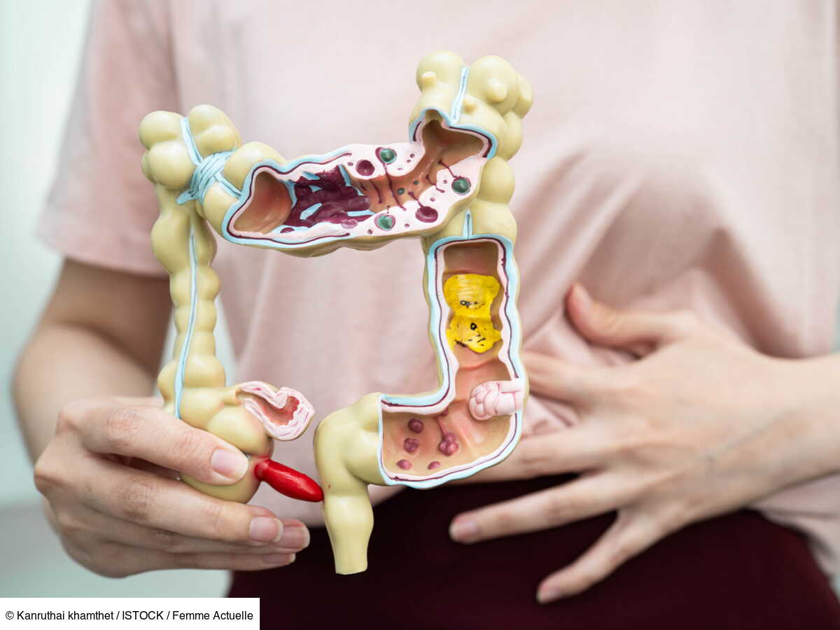 Cancer colorectal : ce facteur de risque s’accumule au fil des années ...