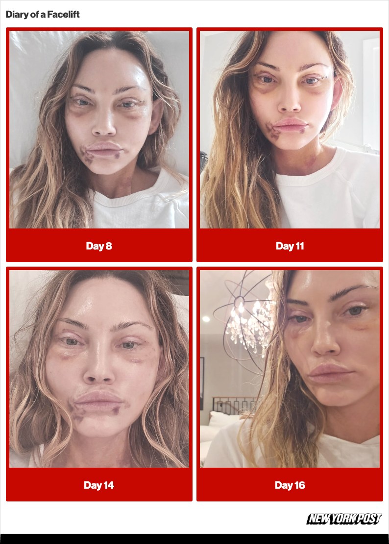 I had a $200,000 Beverly Hills facelift — and then shared every ...