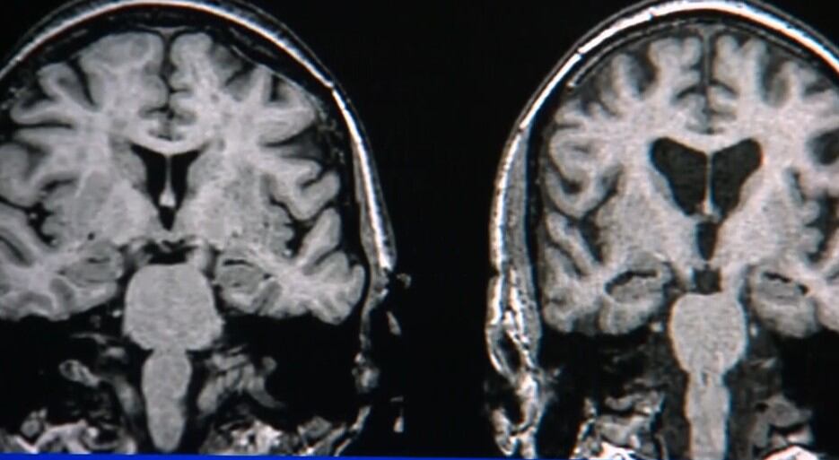 University of Michigan neurologists encourage protecting your brain health