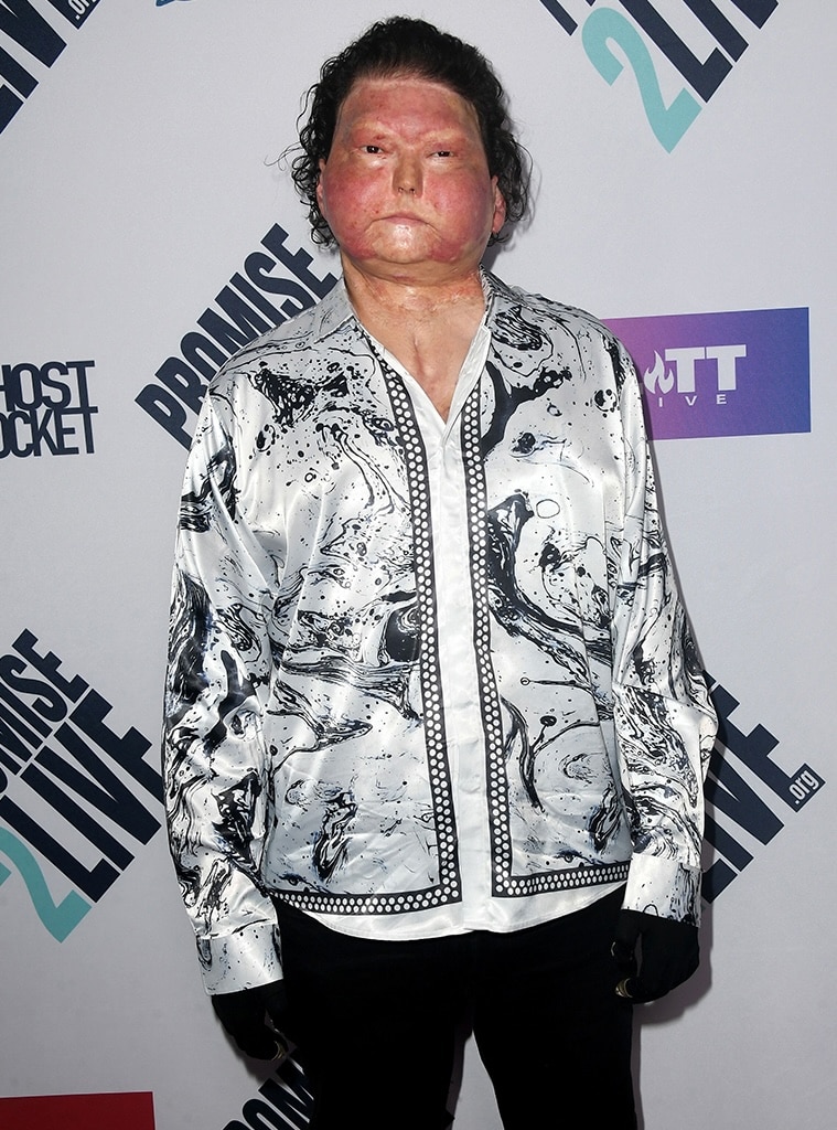 TikToker Joe DiMeo details face transplant after car crash, body burns