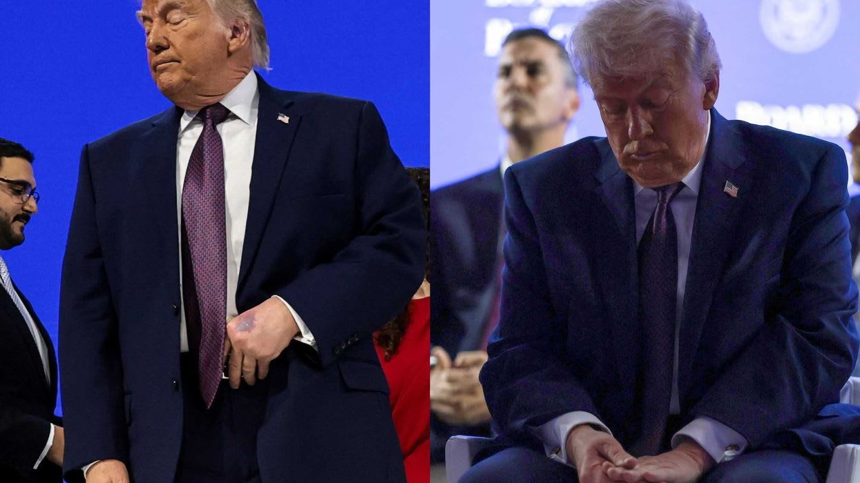 Trump's hand 'looks like rhino hide' and bruise has 'taken over': reporter