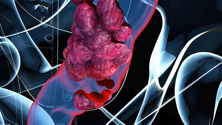 Heavy drinking linked to higher risk of colorectal cancer