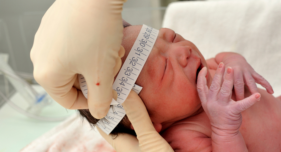 What is microcephaly, and what does it mean for your baby?