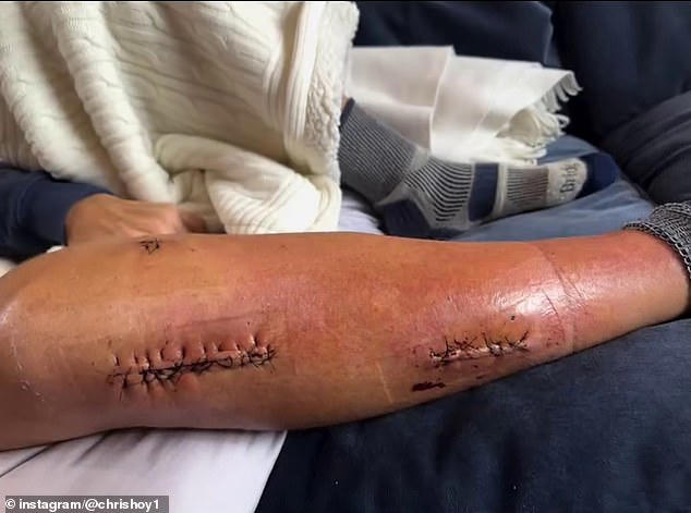 Sir Chris Hoy shares video of his 12-week recovery from broken leg in ...