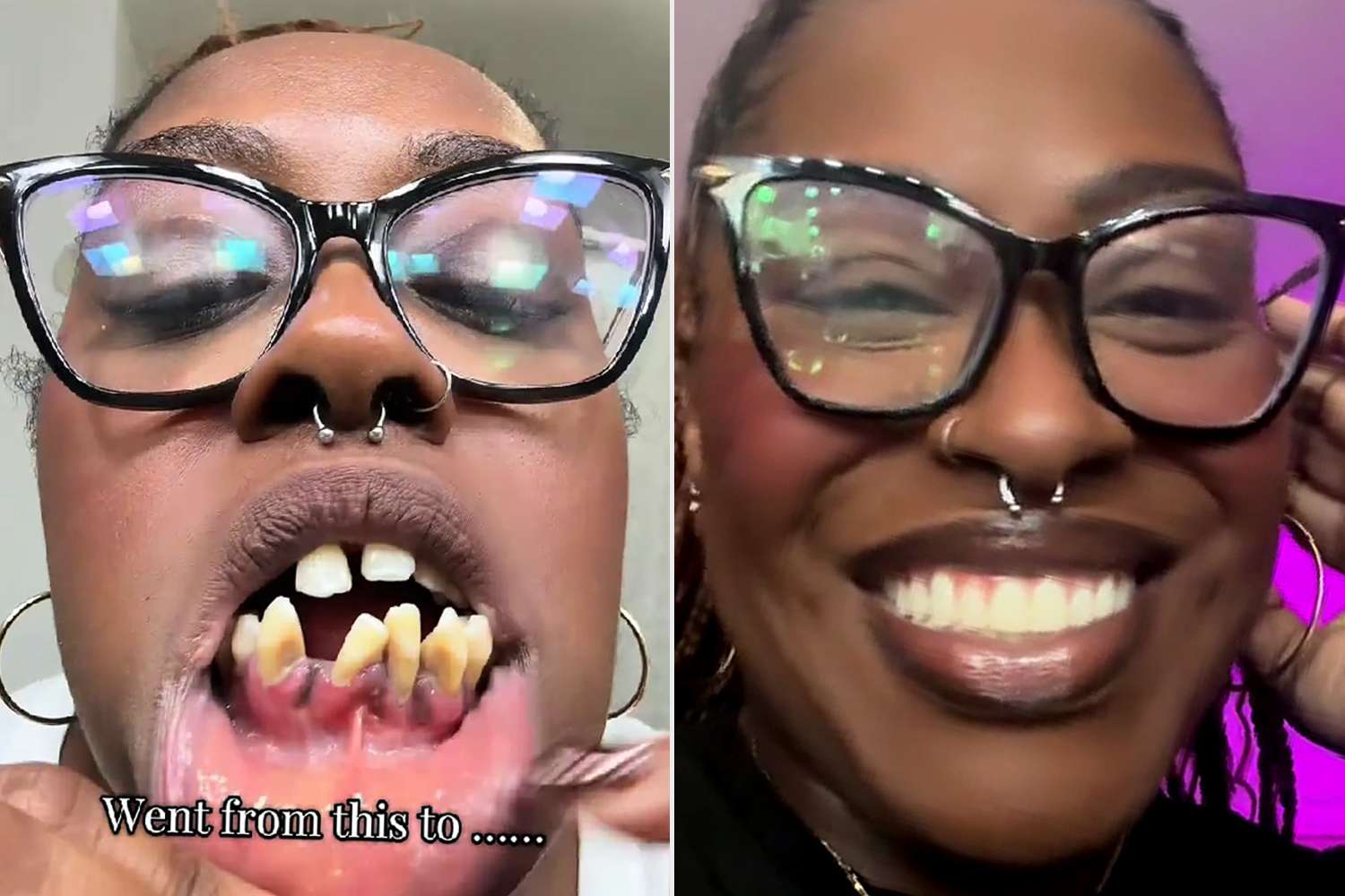 Woman saw 'no signs' of dental disease then lost several teeth. How her ...