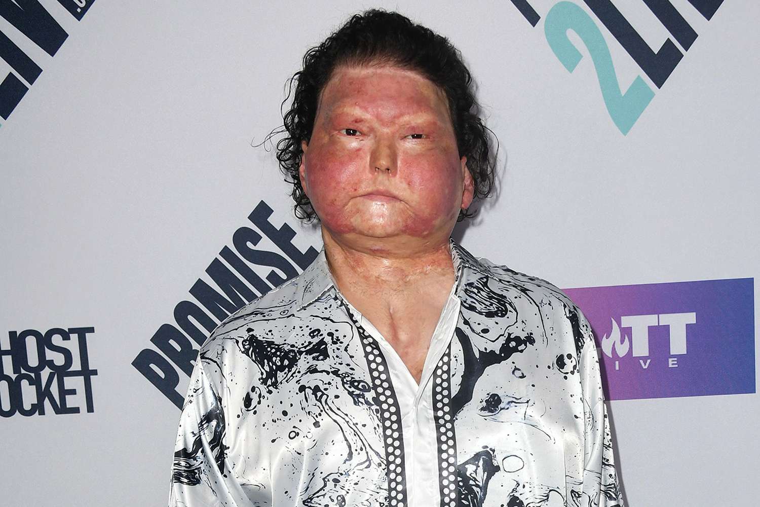 TikToker, 27, who had world's first face and hands transplant, recalls ...