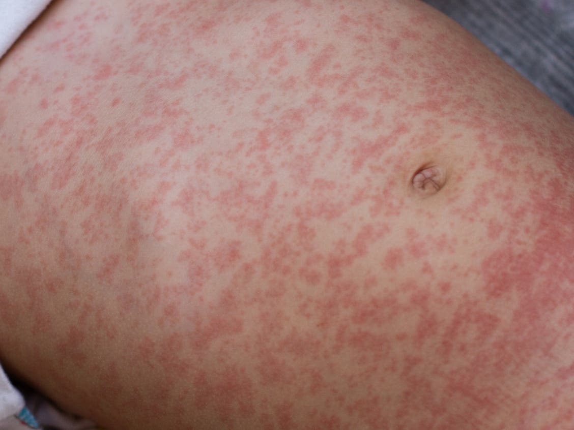 3 measles cases confirmed in FL since Jan. 1, state report says