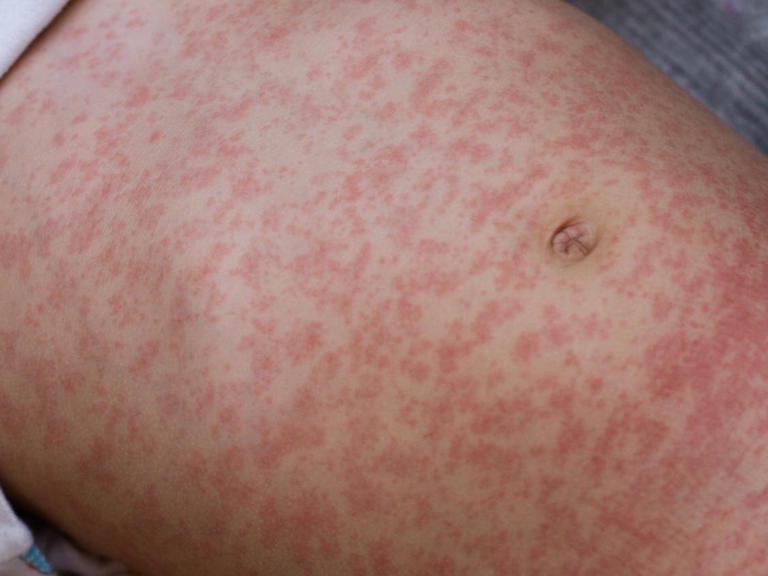 3 measles cases confirmed in FL since Jan. 1, state report says