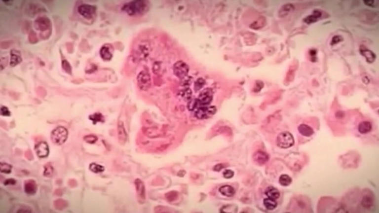 Florida lawmakers advance new vaccine exemption bill as measles cases rise