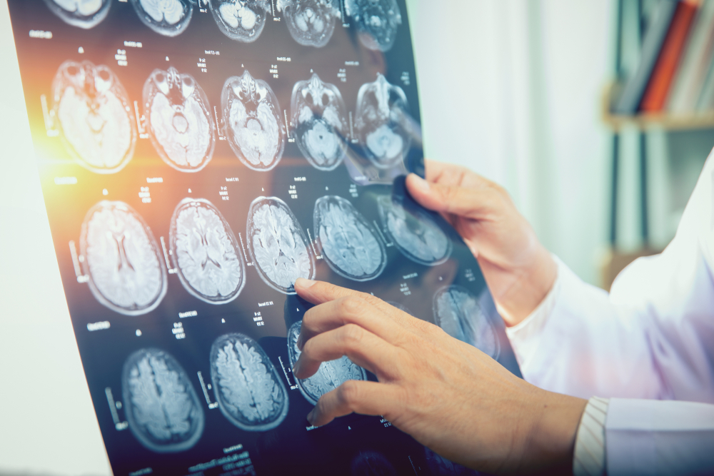 How you can reduce the risk of dementia and stroke, according to a new ...