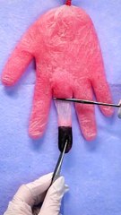 Finger transplant surgery explained #fblifestyle