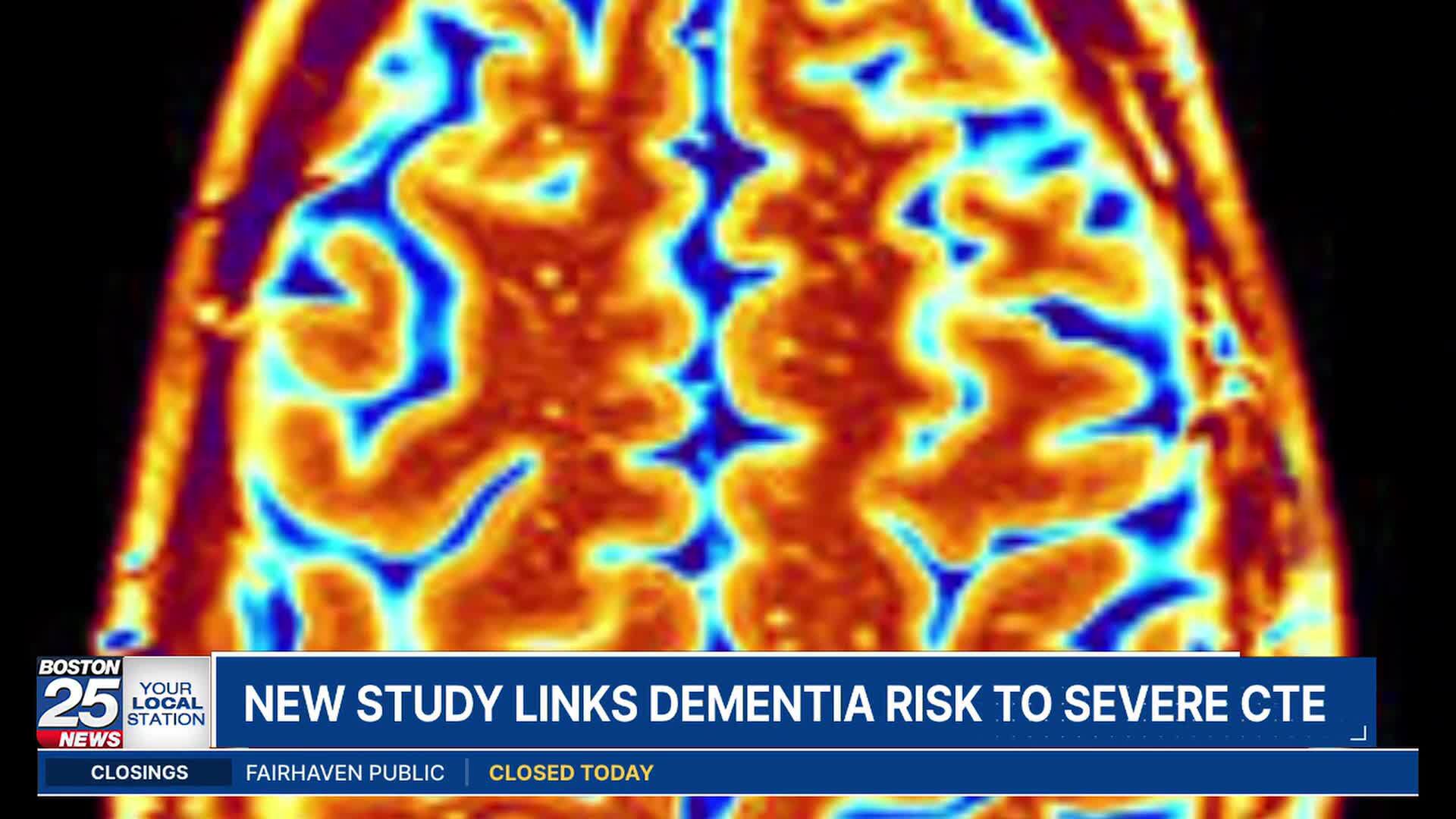 CTE is 'a major contributor to dementia,' BU researchers say