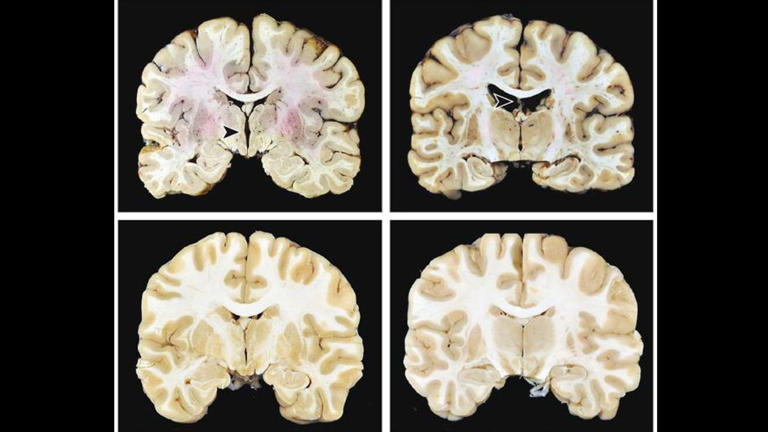 Not all CTE leads to dementia, large study shows