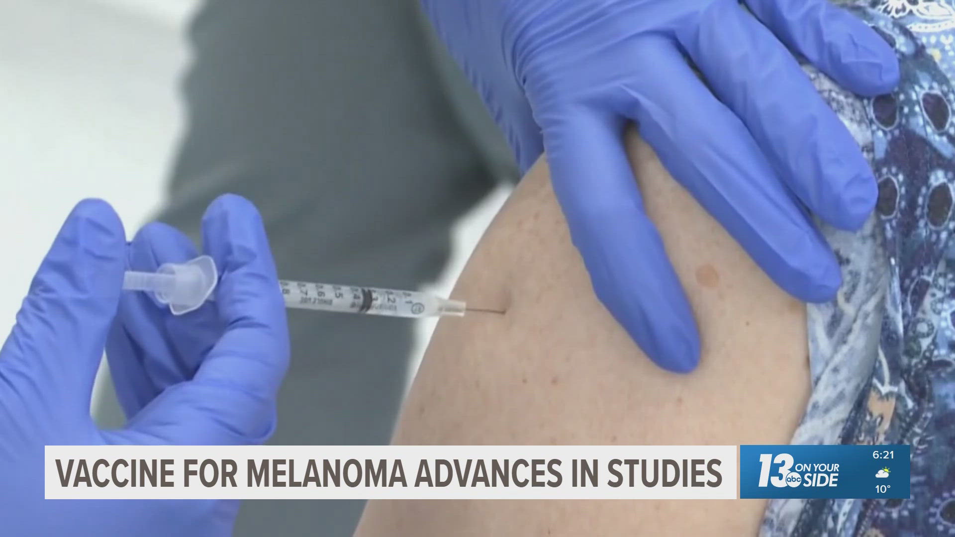 New melanoma vaccine shows promise in preventing skin cancer return