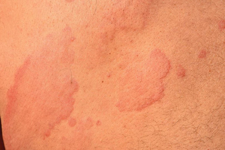 Allergy to cold weather that leaves painful red spots all over your body