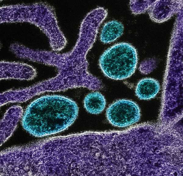 Nipah: entenda o que é o vírus com alto índice de mortalidade que causa ...