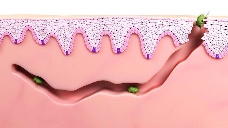 Mum's scabies 'nightmare' as reports of parasitic infestation rise