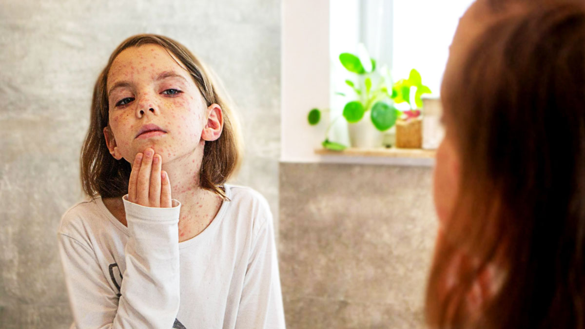 South Carolina measles outbreak hits 789 cases, surpasses Texas