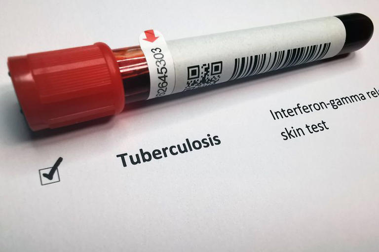 Specialist Birmingham board set up to tackle TB rise