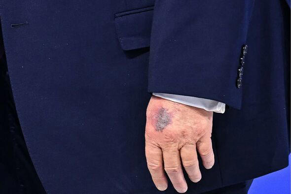 Trump accused of 'hiding' hand bruise as president wears glove amid ...