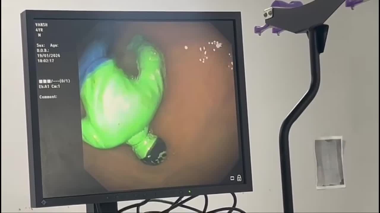 Ahmedabad doctors remove full 'Hulk' toy from toddler’s stomach in high ...