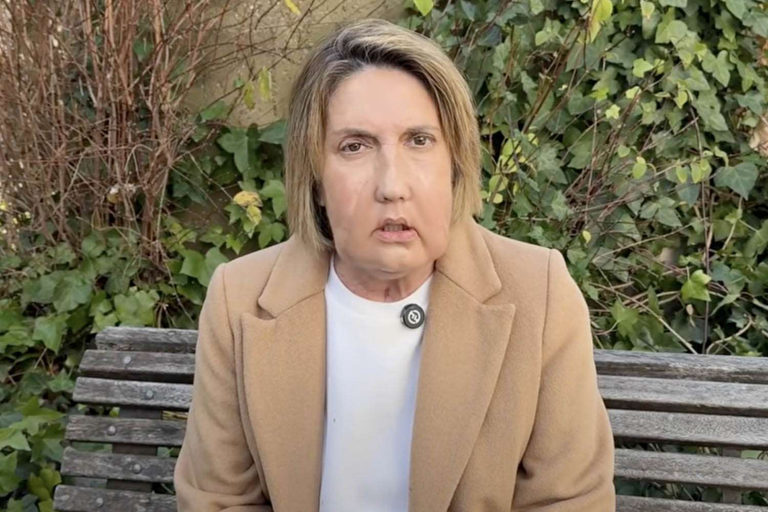 Woman with flesh-eating infection gets new face from donor who chose ...