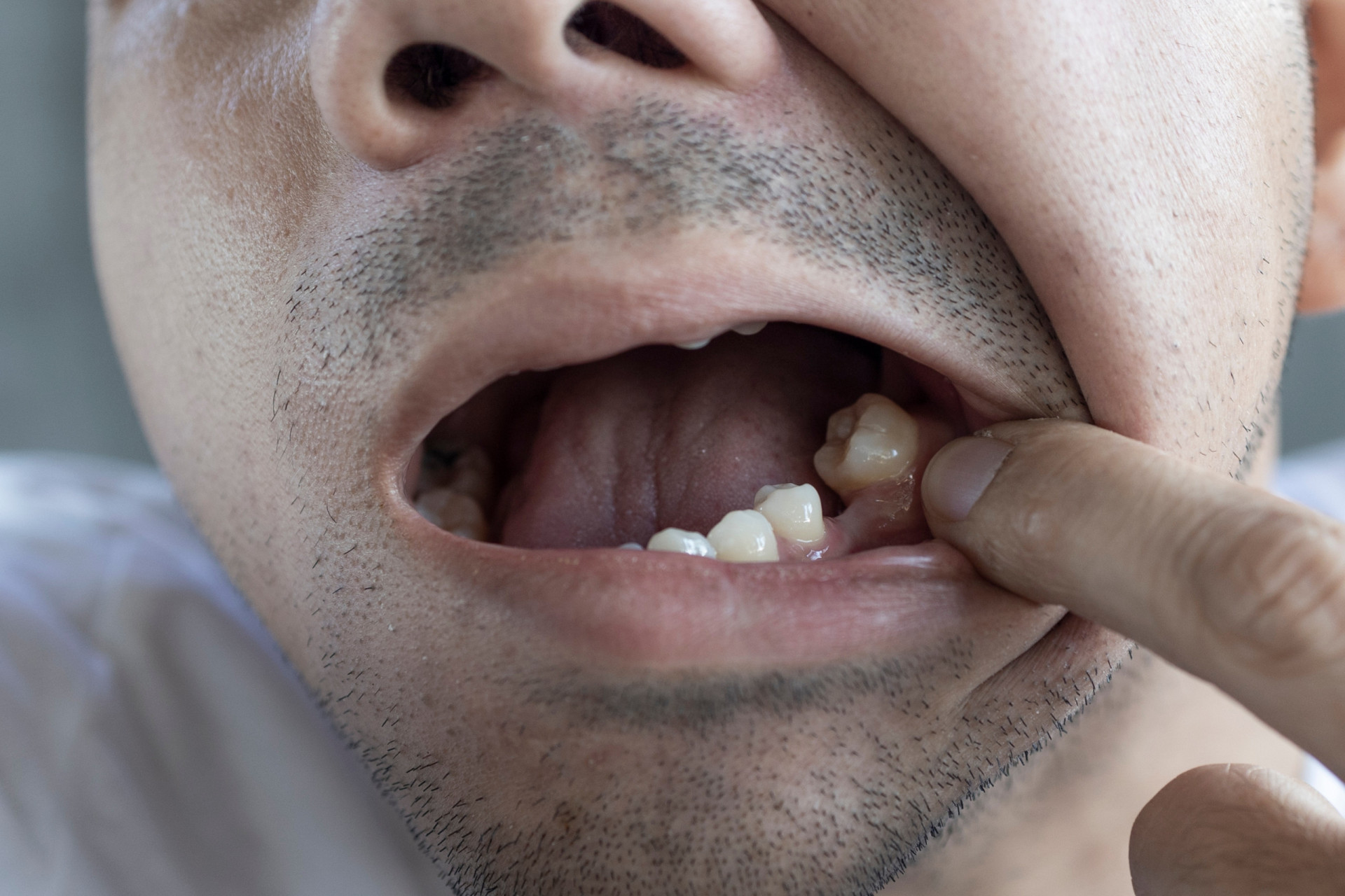 What causes teeth to fall out?