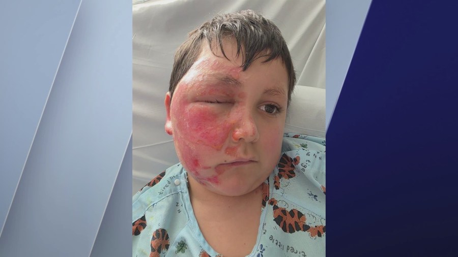 TikTok trend leaves 9-year-old boy with severe burns