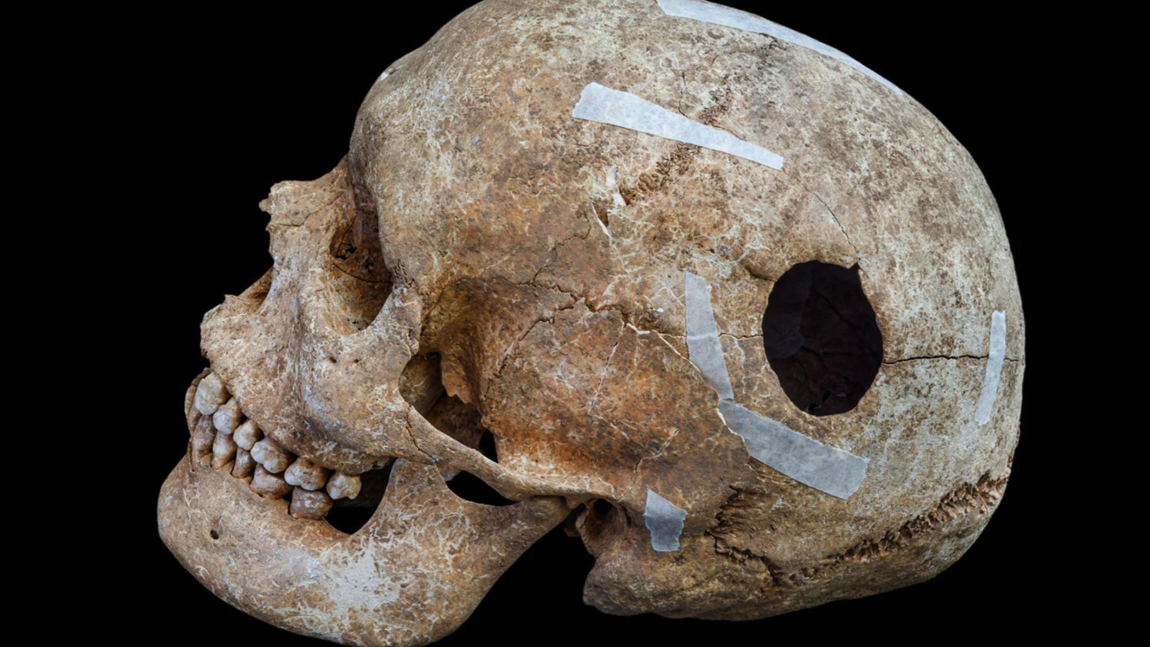 Evidence of world's first surgical procedure on Viking-era man's skull ...