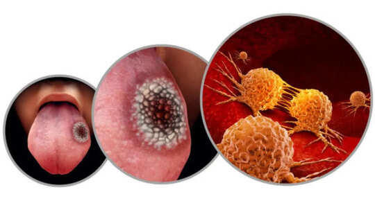 Mouth patches and sores: Early warning signs of oral cancer you shouldn ...
