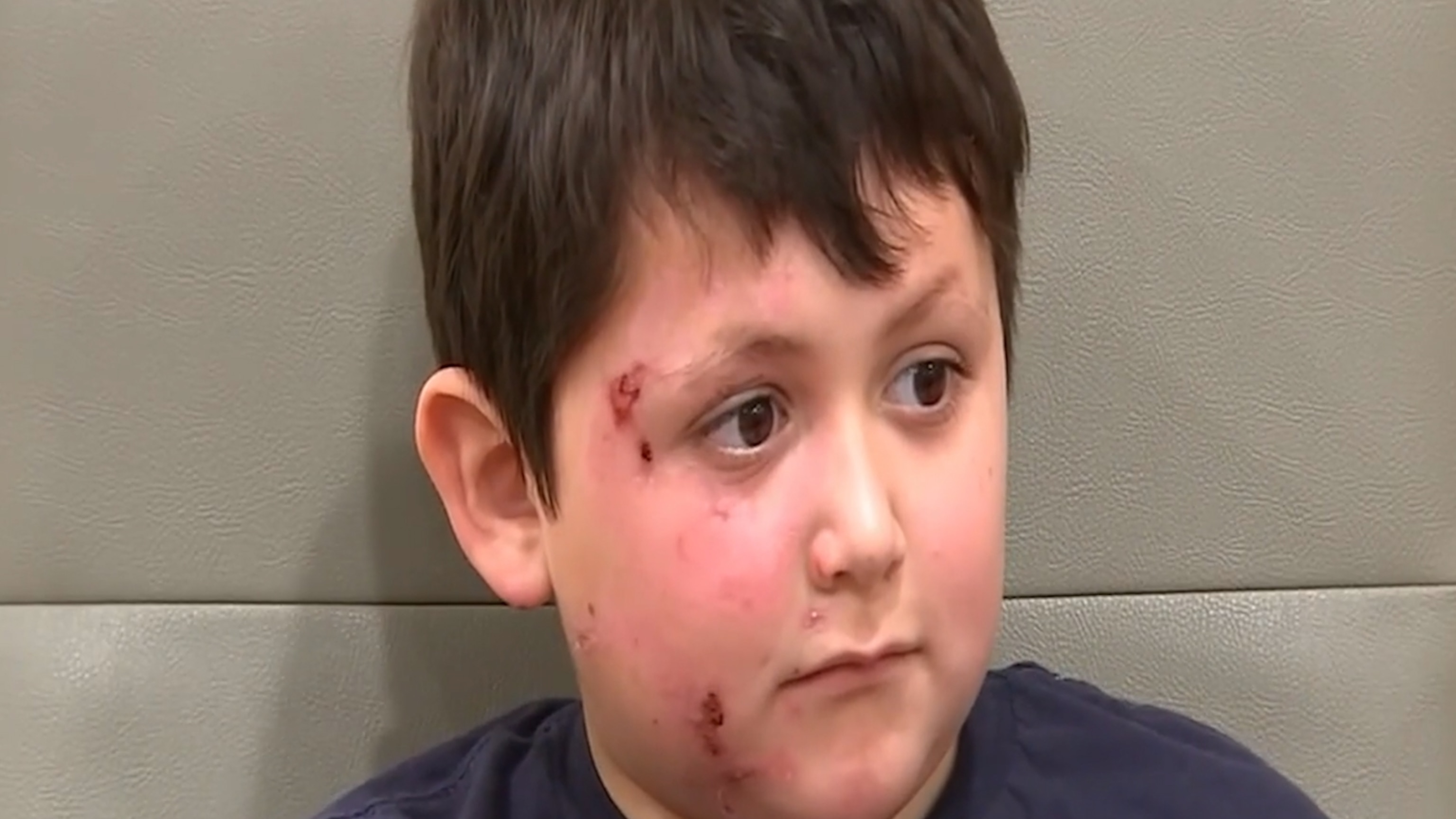 9-year-old boy burns face after putting toy in microwave