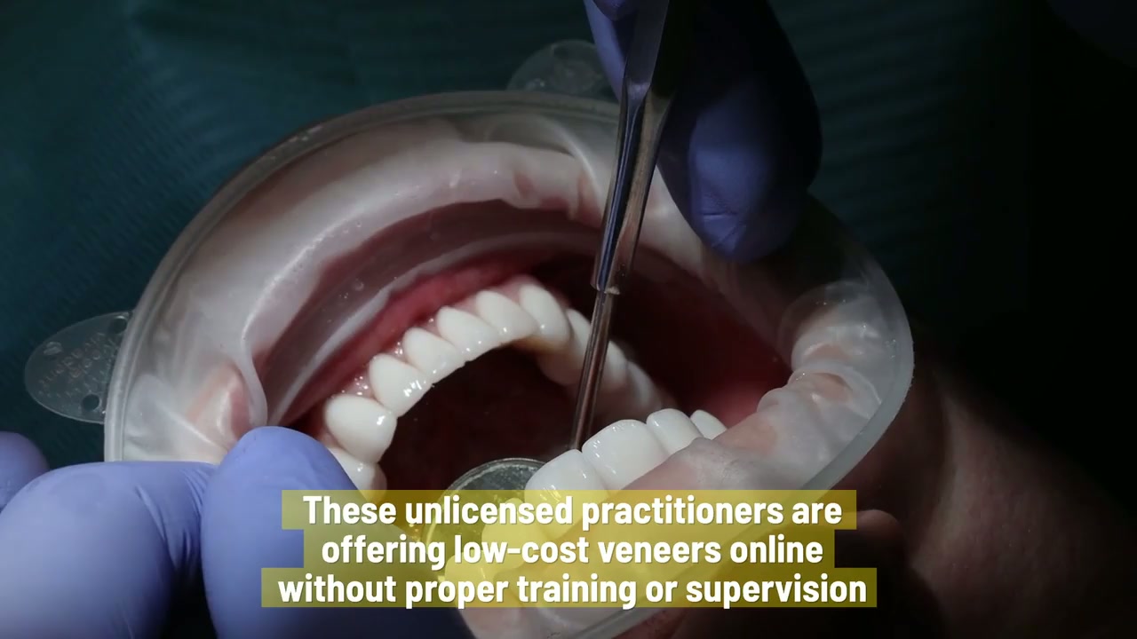 Considering veneers? Here’s what you should know