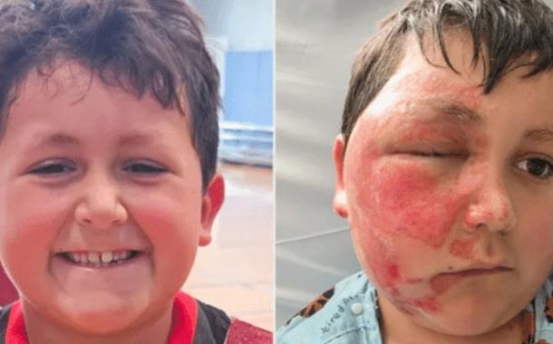 Menino de 9 anos fica gravemente ferido ao imitar desafio viral do TikTok
