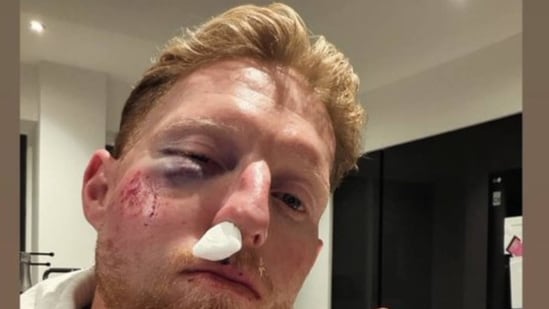 Ben Stokes suffers gruesome facial injury; left with black eye, bloody ...